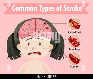 Human with common types of stroke illustration Stock Vector Image & Art ...