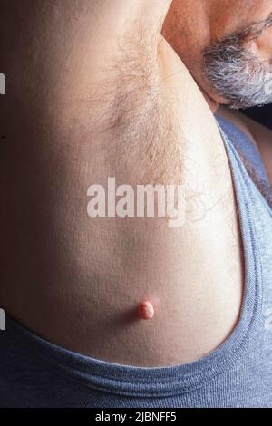 Close Up photo of skin tag or skin mole on a human body swollen and ...