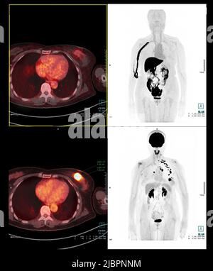 PET Scan image of thorax or chest Comparison Axial , Coronal for detect ...