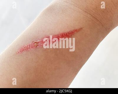 First degree skin burn. Hand burns, wounds. Hot boiling water acts on ...