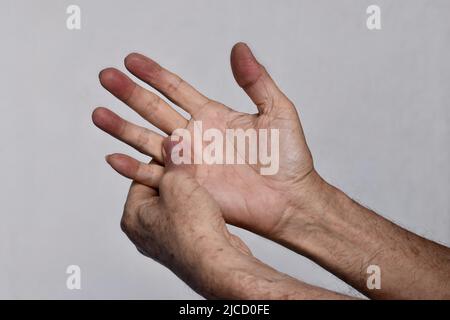 Cyanotic hands or peripheral cyanosis or blue hands at Southeast Asian ...