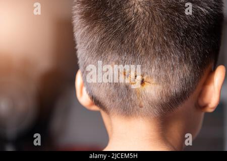 The lacerated sutured wound of kid back head which suture by nylon ...