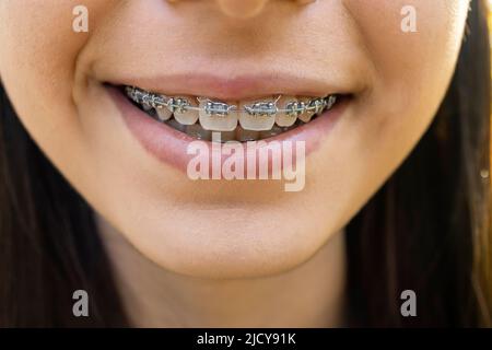 Methods of Teeth Correction Stock Photo - Alamy