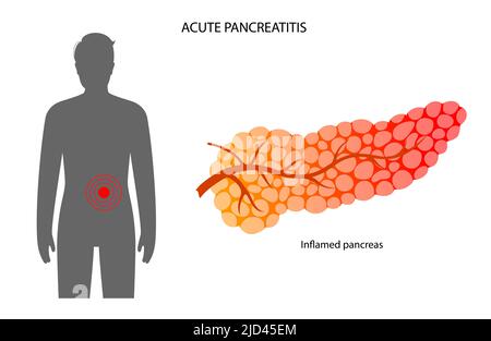 Acute pancreatitis, illustration Stock Photo - Alamy