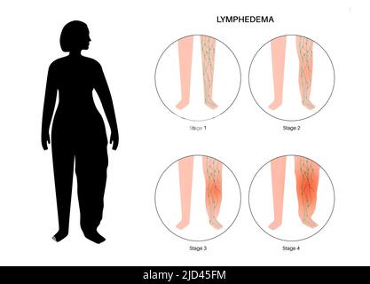 Stages of lymphoedema, illustration Stock Photo - Alamy