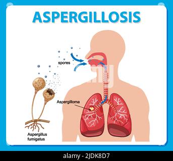 Diagram showing aspergillus infection illustration Stock Vector Image ...