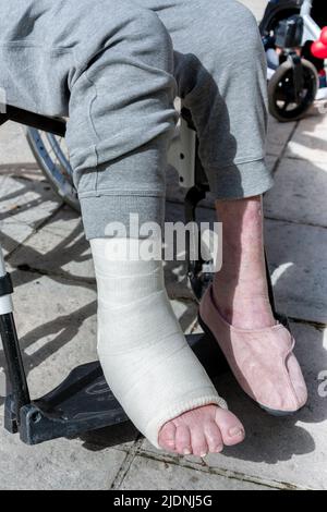 Cast ankle on an elderly person Fracture of the malleolus Stock Photo ...