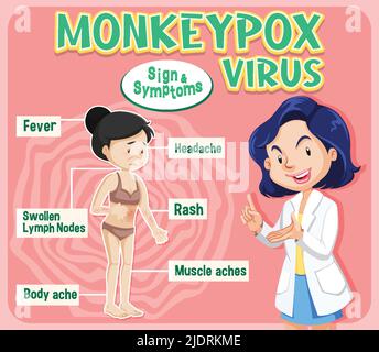 Monkeypox virus sign and symptoms infographic illustration Stock Vector ...