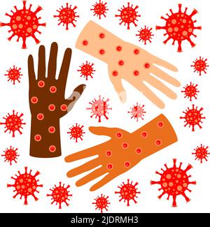 Monkeypox virus, Three human hands of different skin colors in smallpox ...