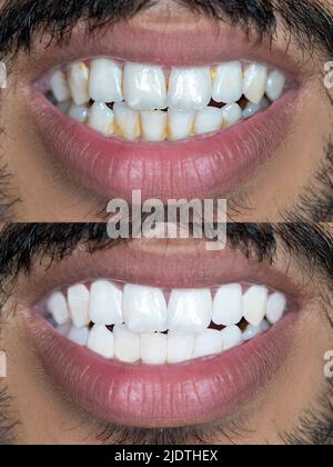 teeth whitening before and after concept. comparision between yellow ...