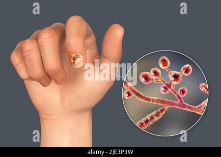 Illustration of a fungal nail infection showing a human hand with ...