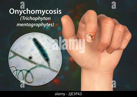 Illustration of a fungal nail infection showing a human hand with ...