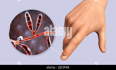 Illustration of a fungal nail infection showing a human hand with ...