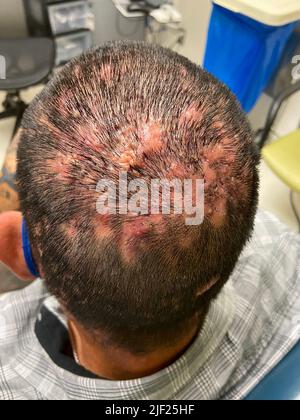 Scalp Cellulitis