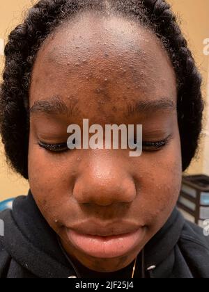Acne from hair products store