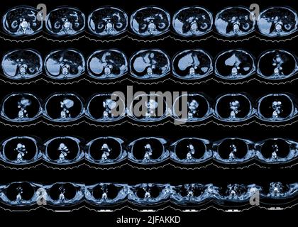Normal lung, CT scan Stock Photo - Alamy