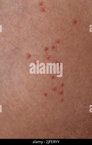 Human skin with various allergic reactions to tick bites with selective ...