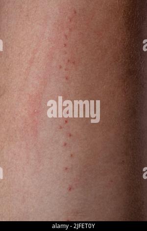 Human skin with various allergic reactions to tick bites with selective ...