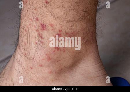 Human skin with various allergic reactions to tick bites with selective ...