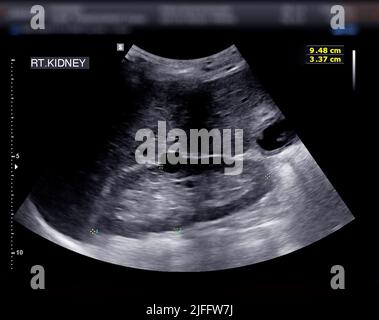 Ultrasound of urinary bladder or KUB for screening renal and bladder ...