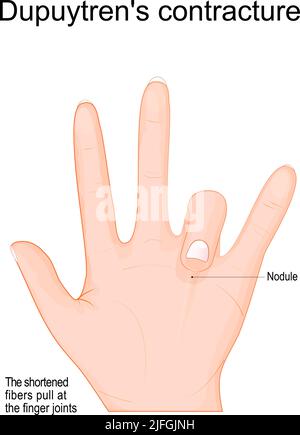 DUPUYTREN'S DISEASE TREATMENT Stock Photo - Alamy