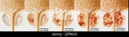 Prostate cancer all 4 stages - detailed close-up - High quality 3d ...