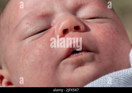 baby face baby with milia acne, engordaderas, keratin accumulations ...