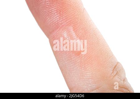 On hand finger there is blister callus with dry skin and trauma on hand ...