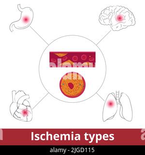 HDL and LDL cholesterol types in blue and yellow ball shapes. Good and ...