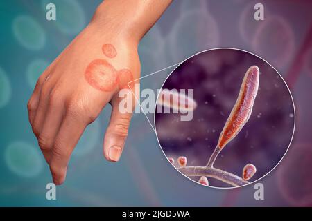 Trichophyton rubrum fungi, artwork Stock Photo - Alamy