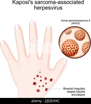 Human Herpesvirus 8 (HHV 8) illustration Stock Vector Image & Art - Alamy