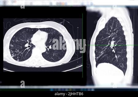 CT scan of Chest or lung axial, coronal and sagittal mip view of lung infection covid-19 with ...