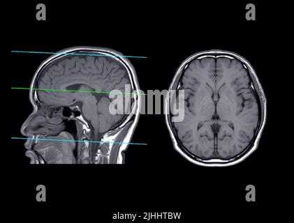 MRI brain compare axial, coronal and sagittal plane for detect stroke disease and Brain tumors ...