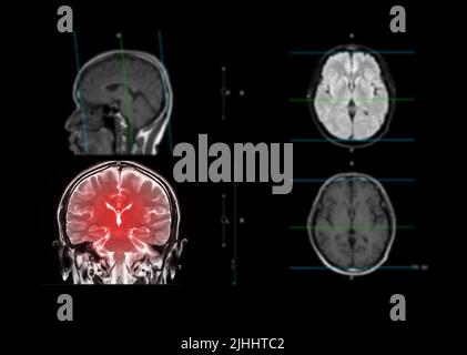 MRI brain scan Sagittal and coronal view with reference line for detect Brain diseases sush as ...