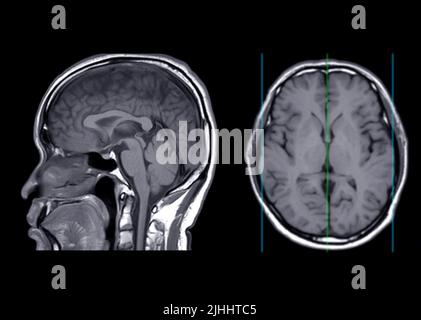 MRI brain axial T1W plane for detect stroke disease and Brain tumors and cysts Stock Photo - Alamy
