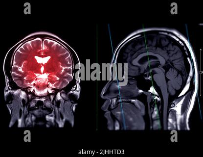 MRI brain scan Sagittal and coronal view with reference line for detect Brain diseases sush as ...