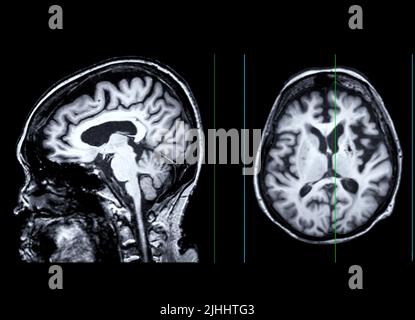 MRI brain scan Axial and sagittal view with reference line for detect Brain diseases sush as ...