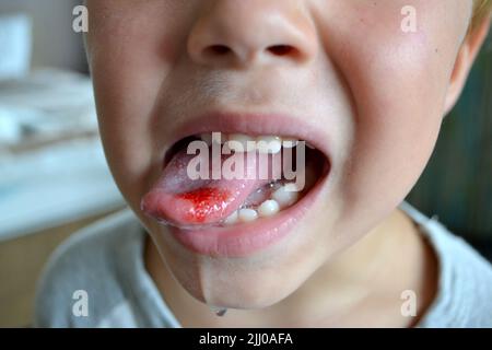 Child's bitten tongue. Close-up of lips, tongue, protrusion of blood ...