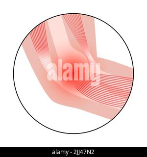 Illustration of golfer's elbow, or medial epicondylitis Stock Photo - Alamy