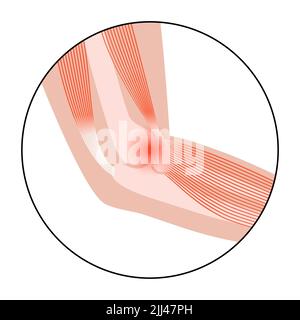 Illustration of tennis elbow, or lateral epicondylitis Stock Photo - Alamy
