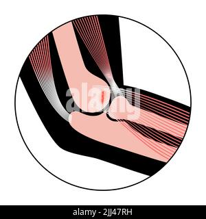 Illustration of tennis elbow, or lateral epicondylitis Stock Photo - Alamy
