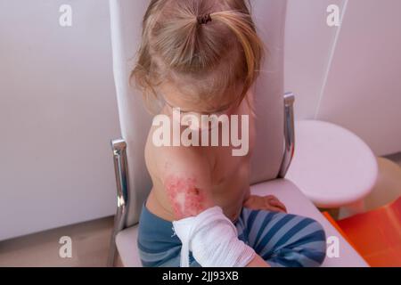 second degree burn on child s hand Stock Photo - Alamy