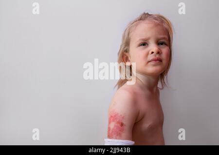 Burned arm of a little child, children burns injuries, cute trouble boy ...