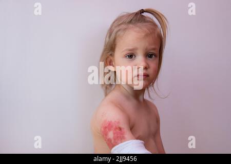 Burned arm of a little child, children burns injuries, cute trouble boy ...