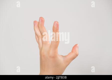 A human hand with an unnaturally bent joint. Ankylosis of the joints of ...
