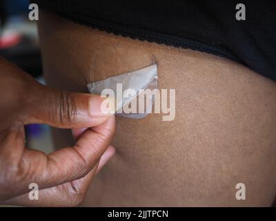 HRT Patch being peeled from the skin of a woman of colour Stock Photo ...