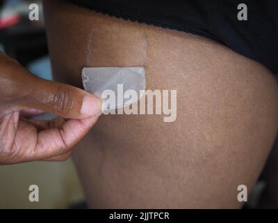 HRT Patch being peeled from the skin of a woman of colour Stock Photo ...