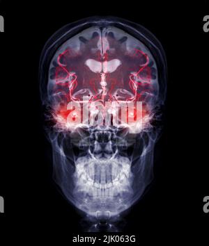 MRA Brain or Magnetic resonance angiography of cerebral artery in the ...