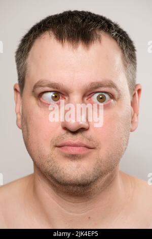 A man with strabismus squints his eyes on a white background Stock ...