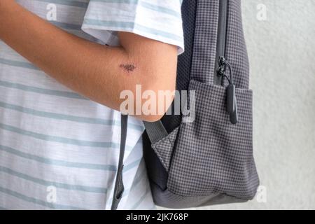 Abrasion. Deep wound on the skin. Deep scratches on the skin with ...